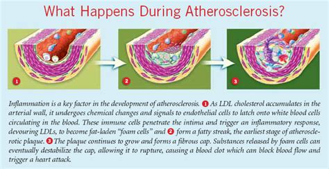 Atherosclerosis