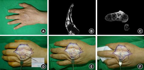 Figure 2 From Rupture Of The Extensor Digitorum Communis Tendon In Extensor Zone V Due To Plant