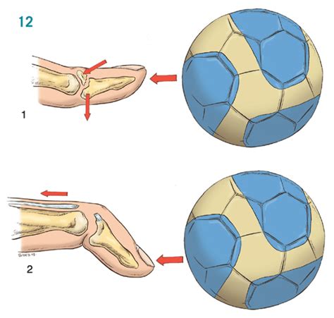 Five Common Netball Injuries Sports And Spinal Albury