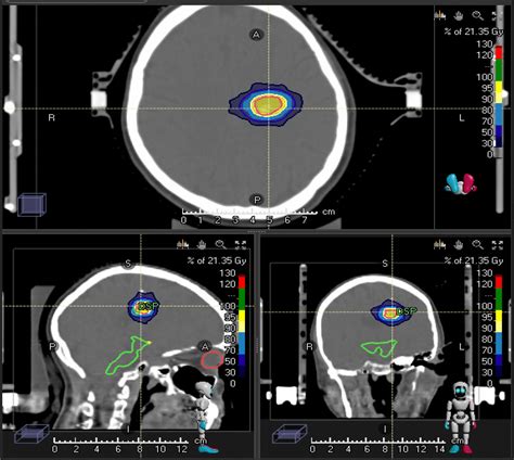 Linac Based Stereotactic Radiosurgery For Brain Arteriovenous Malformations Pmc