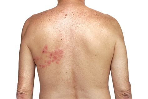 Effective Shingles Treatments At Our Clinic In Chapel Hill