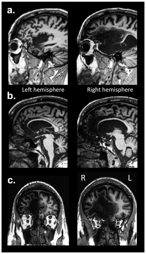 A Sagittal Images Highlighting Damage To The Insular Cortex B