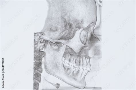 Ct Scan Of A Patient With Malocclusion Missing Chewing Tooth And