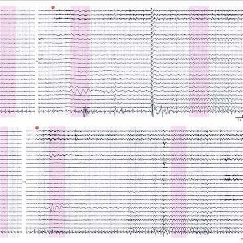 Interictal And Ictal Eeg Data Seizure Onset And Termination Are Marked