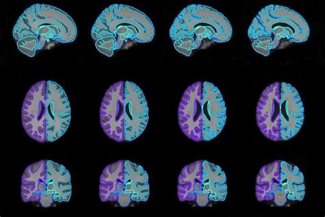 Application Of Deep Learning In Medical Image Analysis