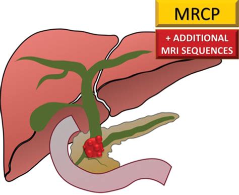 MR Cholangiopancreatography What Every Radiology Resident Must Know RadioGraphics