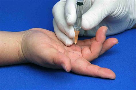 Everything You Should Know About Xiaflex Injection Wellness Info