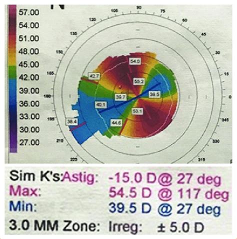 Pre Surgical Topography Download Scientific Diagram