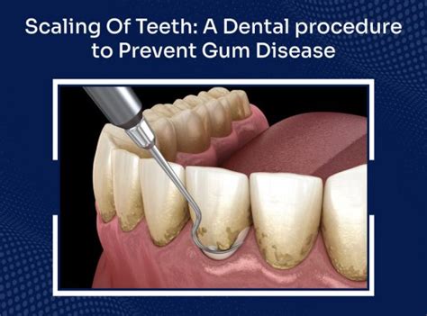 Scaling Of Teeth A Dental Procedure To Prevent Gum Disease