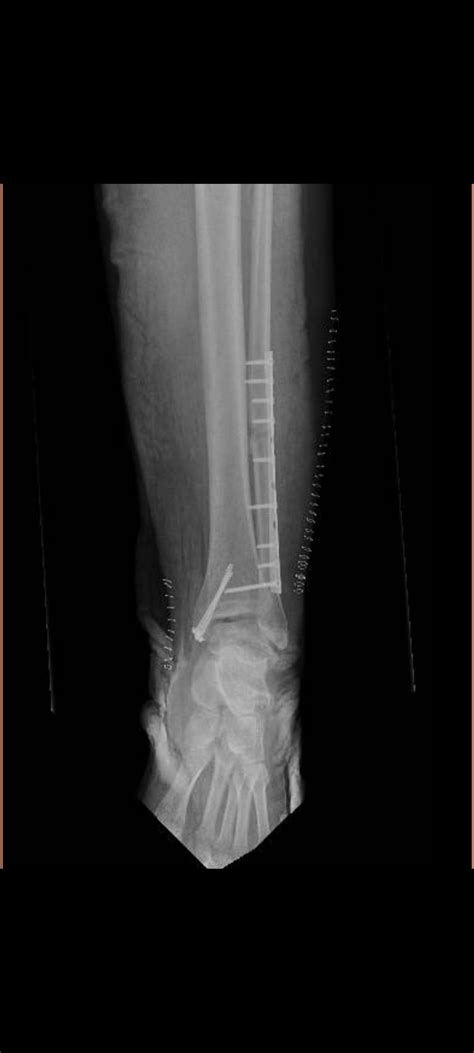 Colles Fracture Questions Rbrokenbones Colles Fracture Questions Rbrokenbones