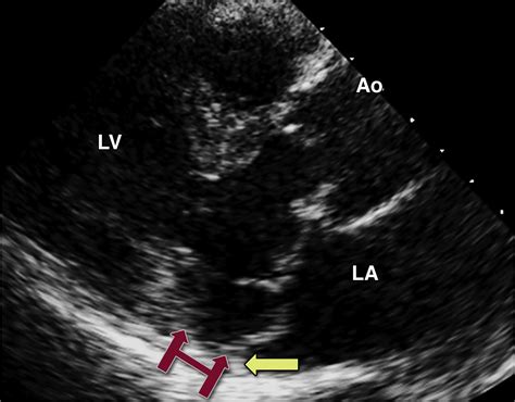 Mitral Annular Disjunction The Forgotten Component Of Myxomatous
