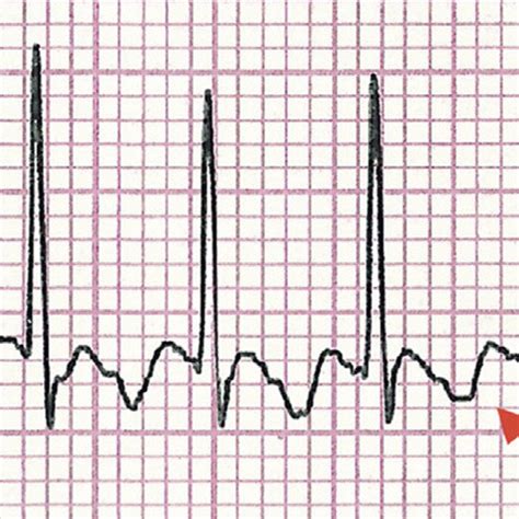 Intracardiac Umbilical Venous Catheter In The Left Atrial Region Download Scientific Diagram
