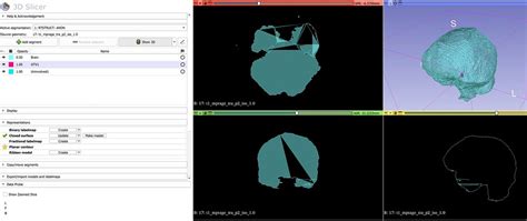 conversion of planar contours to closed surfaces of rt structs is