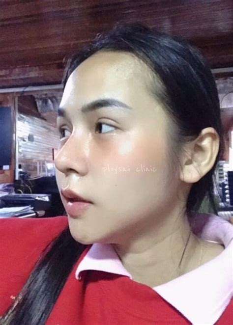 🌺 เคสนี้ก่อนแก้ฐานเอียง ทำให้จมูกเอียงไปด้วย 🌺 หมอพลอยเลยตรวจดูฐานอย่างละเอียดและเหลาซิลิโคนให้