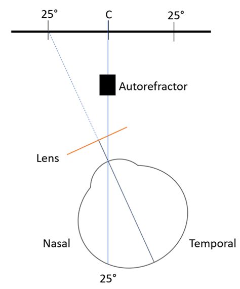 Peripheral Refraction And Visual Function Of Novel Perifocal Ophthalmic
