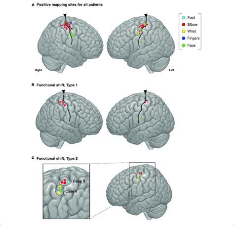 Positive Mapping Of Motor Function Sites During Awake Surgery A Download Scientific