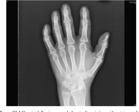 Figure 1 From Proximal Row Carpectomy Versus Four Corner Arthrodesis As A Treatment For Slac