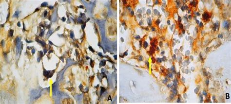 immunohistochemical staining shows ocn expression yellow arrow 1000x