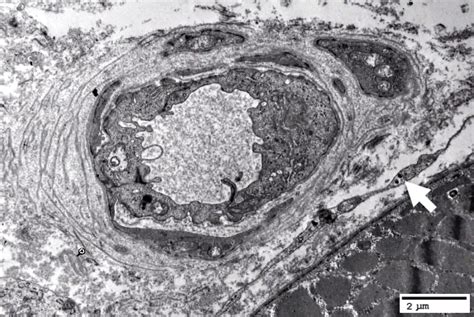 Small Vessel Vasculopathy