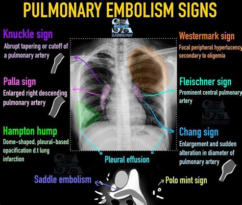 Pulmonary Embolism Signs Medizzy