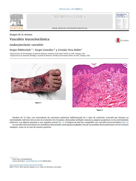 Pdf Vasculitis Leucocitoclástica