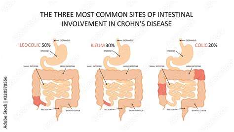 Three Most Common Sites Of Intestinal Involvement In Crohns Disease