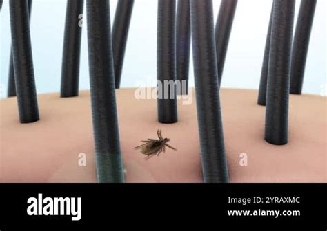 Bacterial Skin Disease Stock Videos And Footage Hd And 4k Video Clips Alamy