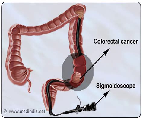 Sigmoidoscopy Procedure