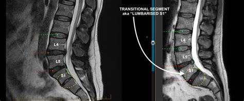 “lumbarised S1” The Transitional Potentially Mobile Lumbosacral Segment And Its Excellent
