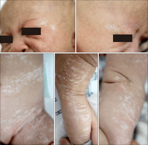 Hypopigmentation Face
