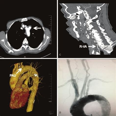 A Type B Aortic Dissection With Descending Thoracic Aortic Dissection Download Scientific