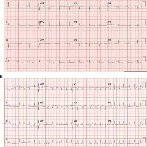A 12 Lead Ecg A On Presentation And Telemetry Tracing B During Download Scientific Diagram