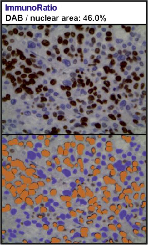 Ki67 Immunohistochemistry Proliferation Index Pi 46 Assessed With