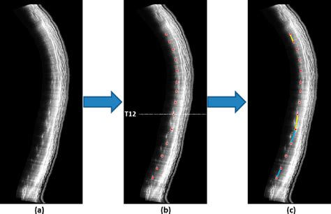 Figure 2 From Sagittal Spinal Alignment In People With Chronic Spinal