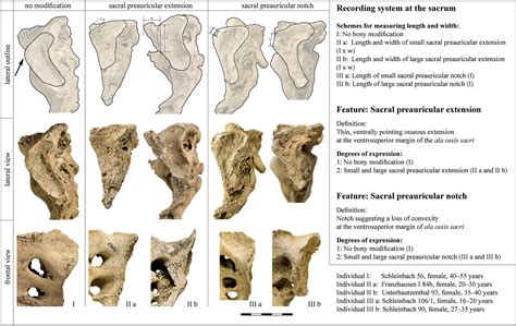Preauricular Sulcus