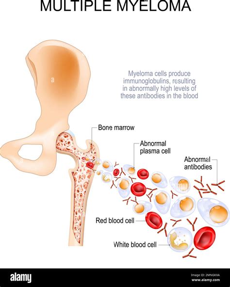Multiple Myeloma Myeloma Cells In Bone Marrow Produce Immunoglobulins