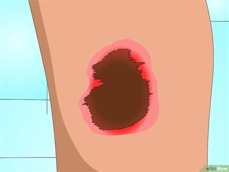 How To Get Rid Of Acne Scabs Fast Effective Ways