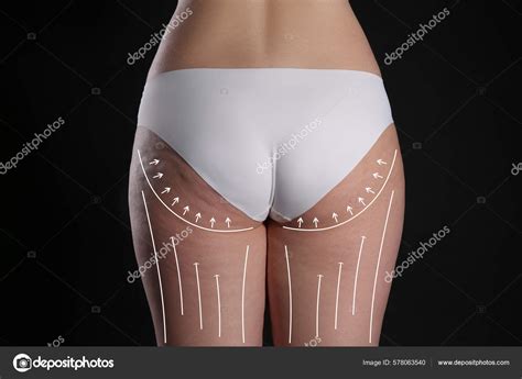 Woman Marks Body Cosmetic Surgery Operation Black Background Closeup Stock Photo By NewAfrica
