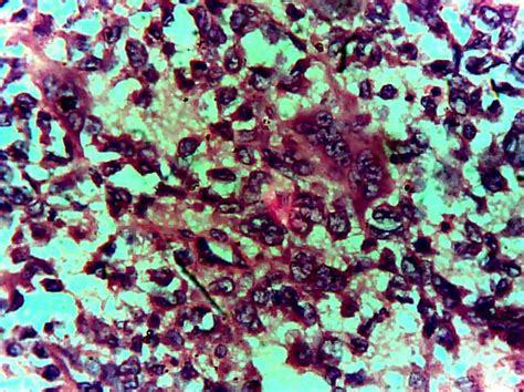Histologic Section Showing Tumour Cells Having Moderately Pleomorphic