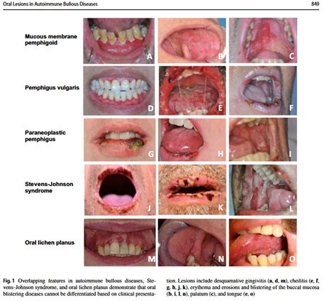 Gingival Erythema Bauer Smiles
