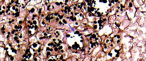 Grocott Gomori Methenamine Silver Stain With Evidence Of Cryptococcus