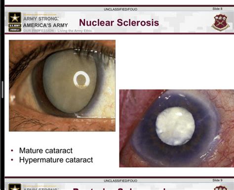 Ophthalmology Lens And Vitreous Disorders Flashcards Quizlet