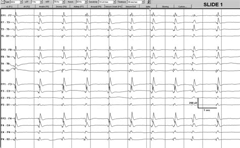 Interrater Reliability Of ICU EEG Research Terminology Journal Of Clinical Neurophysiology