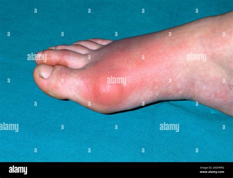 Gout The Foot Of A Patient With Gout Showing An Inflamed Reddened