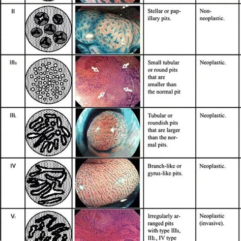 Kudo Classification Of Pit Patterns With Photographic Correlation Of Download Scientific