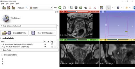 how to load a stl segmentation onto a dicom file with 3d slicer