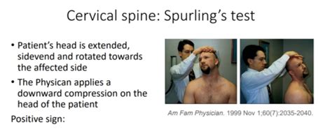 What Is A Positive Spurling Sign