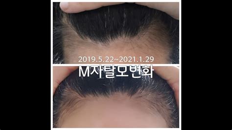 여자m자탈모 여성m자탈모 헤어라인 이마에서 머리가 나와요 Youtube