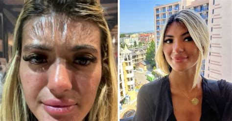 Woman Fell Asleep In Sun Wakes Up With Plastic Forehead