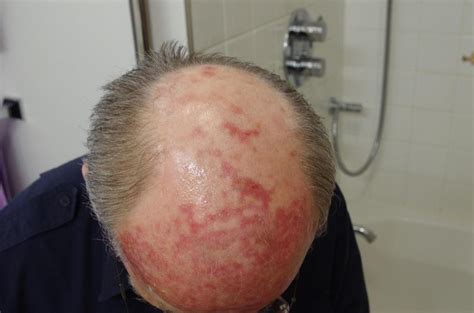 Scalp Edema Query